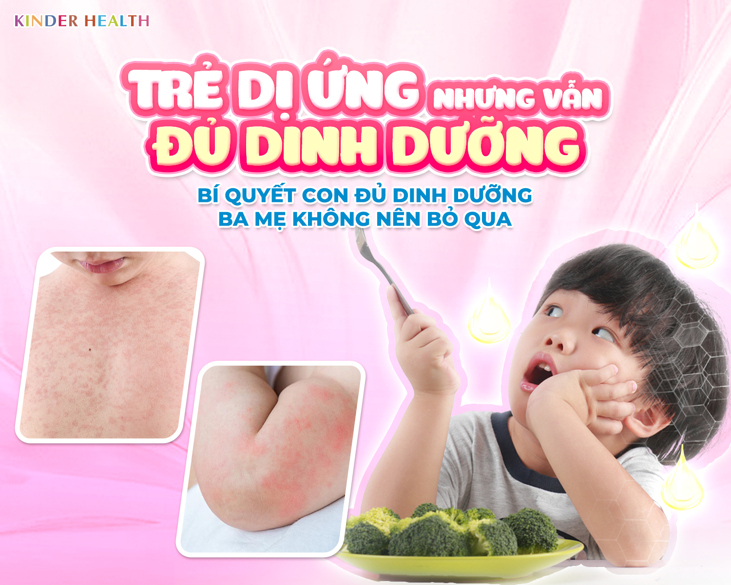TRẺ DỊ ỨNG NHƯNG VẪN ĐỦ DINH DƯỠNG - BÍ QUYẾT CON ĐỦ DINH DƯỠNG BA MẸ ...